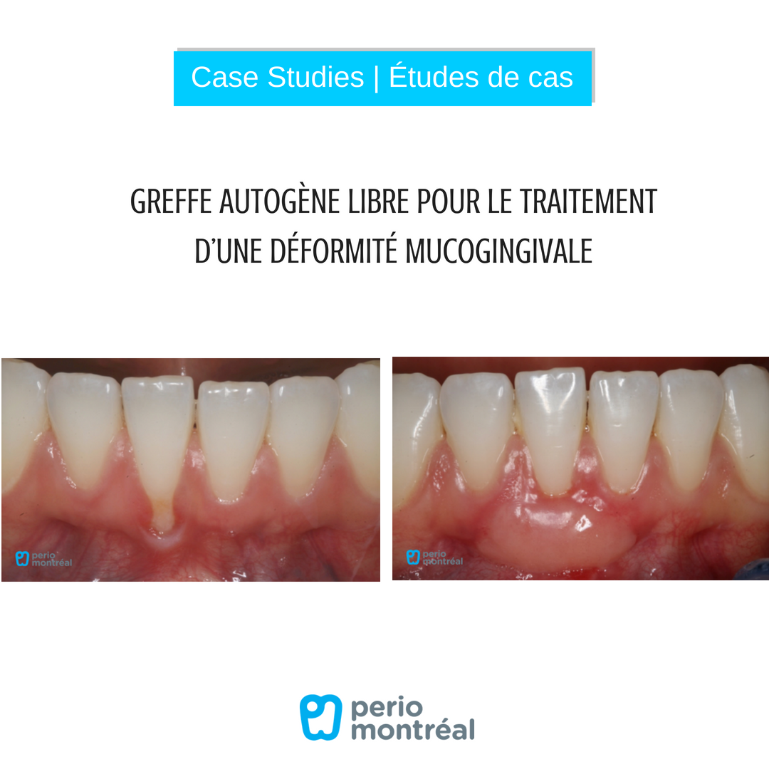 Greffe autogène libre pour le traitement d'une déformité mucogingivale ...